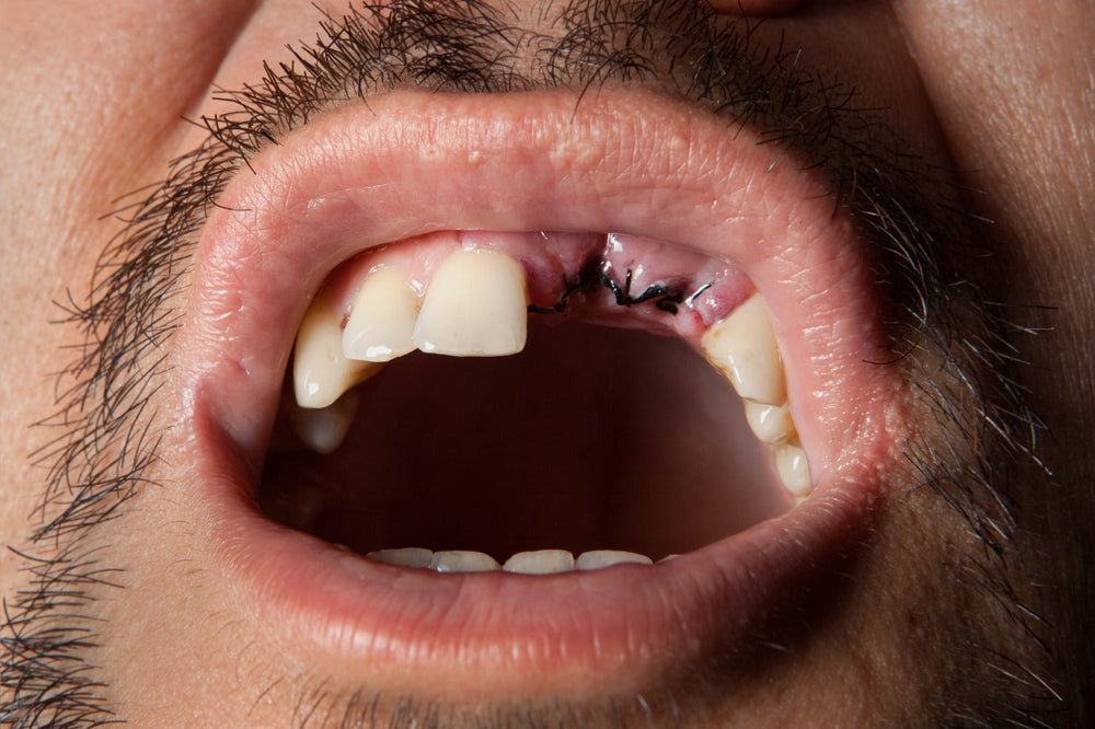 Dental Sutures In 2023: What To Consider